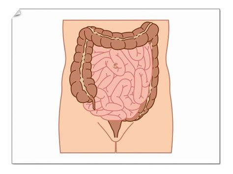Print Of Digital Illustration Of Location Of Intussusception In Small