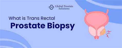What Is Transrectal Prostate Biopsy Prostate Cancer Test