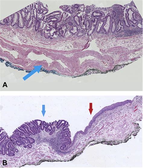 Novel Approaches To Minimize Intraoperative Bleeding During Endoscopic