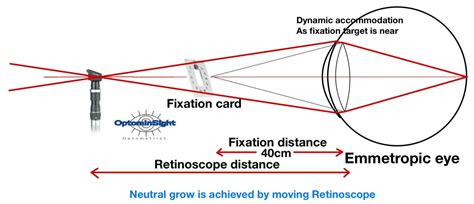 Nott Dynamic Retinoscopy Technique Archives Optominsight