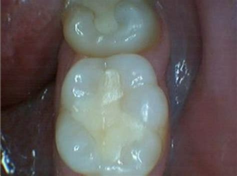 Restorations Flashcards Quizlet