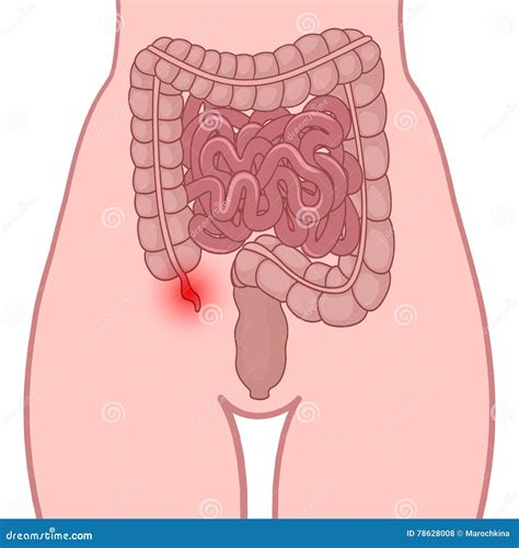 Appendicitis Inflammation Of The Appendix Colon The Illustration On Background