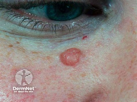Nodular Basal Cell Carcinoma Images