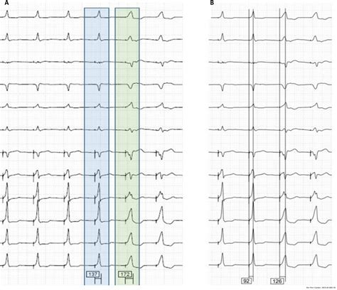 His Bundle Pacing And Left Bundle Branch Area Pacing Feasibility And Safety Revista
