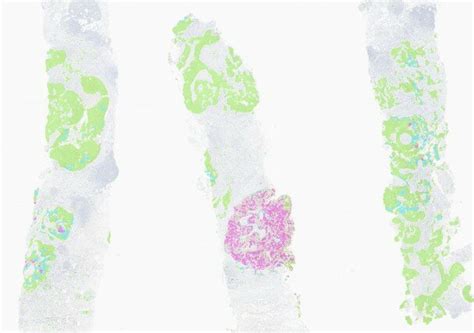 her2 class map generated by our model invasive cancer of her2 class 0