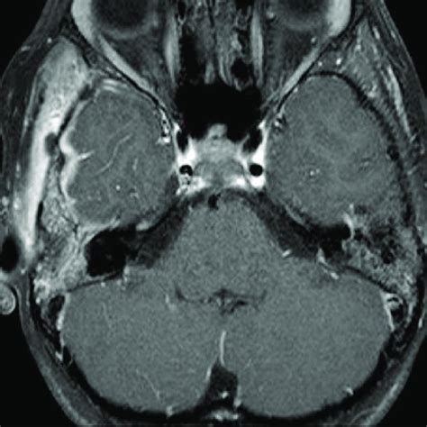 Unilateral Temporal Swelling Asterisk Download Scientific Diagram