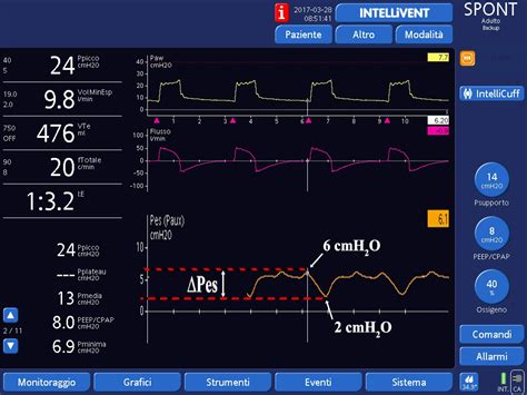How To Monitor Inspiratory Effort Triggerlab