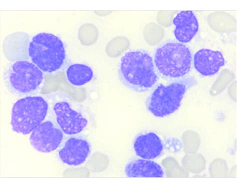 Tumor Cells In Bone Marrow Aspirate Smear Show Lymphoblastoid Features