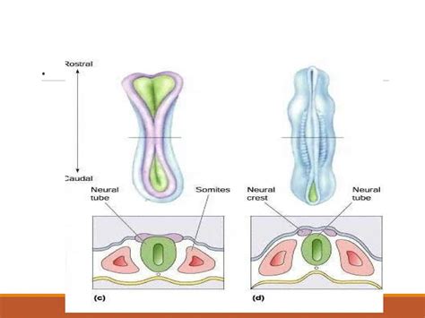 Spinal Dysraphism Embryology And Prsentation Pptx