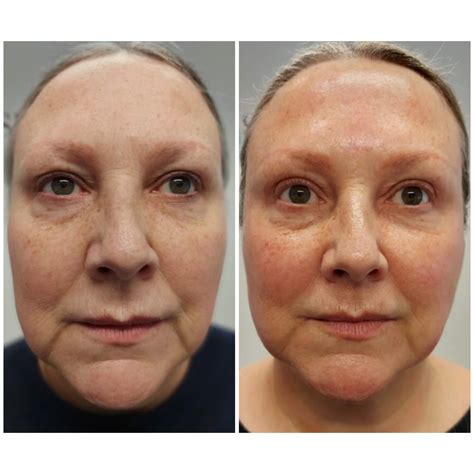 Radio Frequency Injection Queen