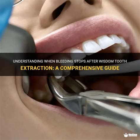Understanding When Bleeding Stops After Wisdom Tooth Extraction A Comprehensive Guide Medshun