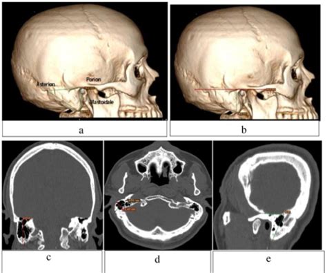 Sex Determination By Ct Scan Analysis Of The Mastoid Bone A Cross