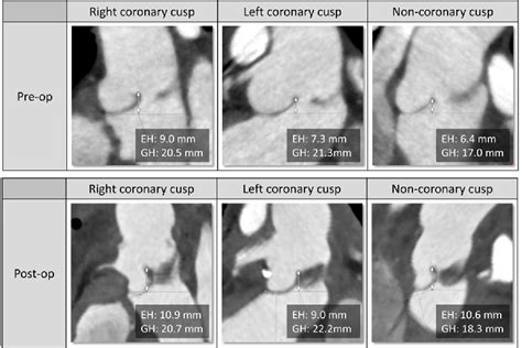 Figure 1 From Total Root Remodelling By The Sleeve Technique For Aortic
