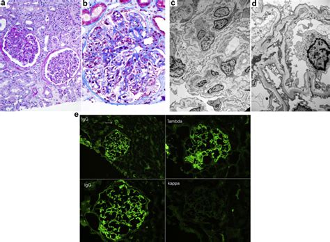 Anti Glomerular Basement Membrane Disease What Have We Learned Openbasement