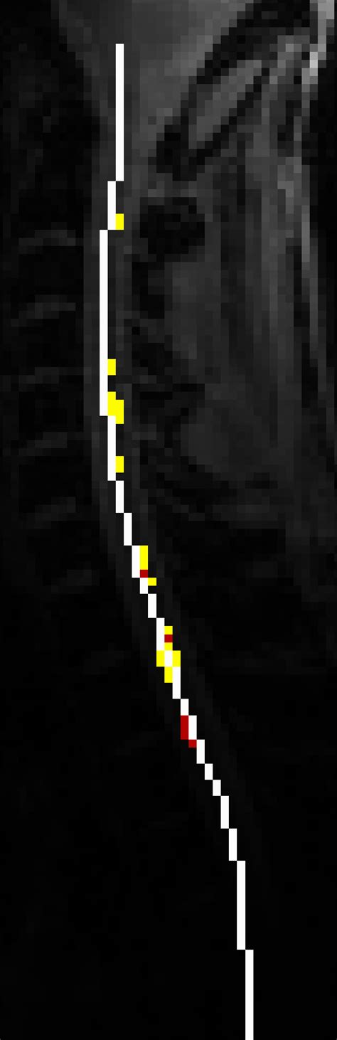 Get Centerline Finds The Centerline But Deepseg Fails To Find The Sc
