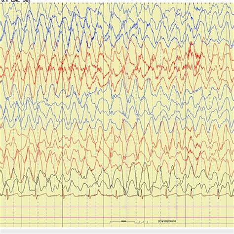 Video EEG Findings With The Evolution Of Generalized Rhythmic Delta Download Scientific Diagram