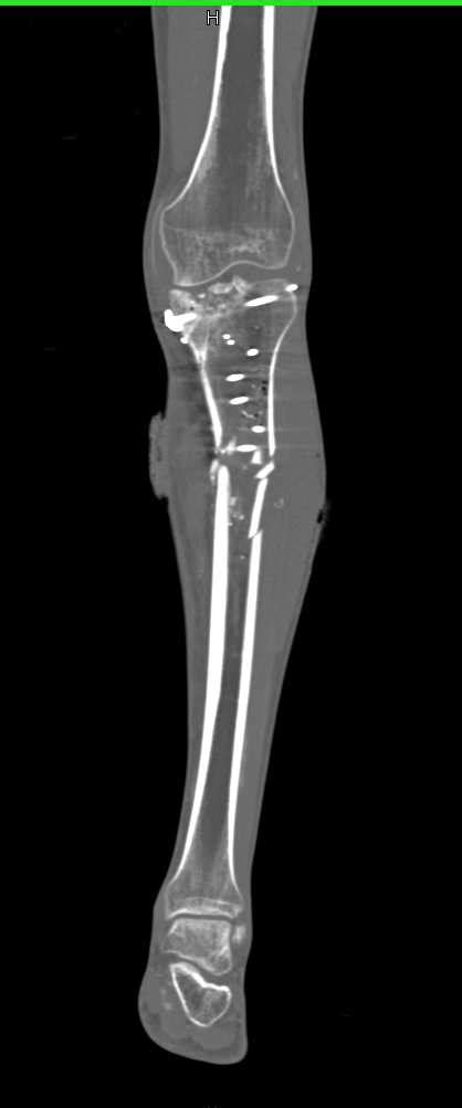 Comminuted Fracture Tibia Musculoskeletal Radiology Case Studies
