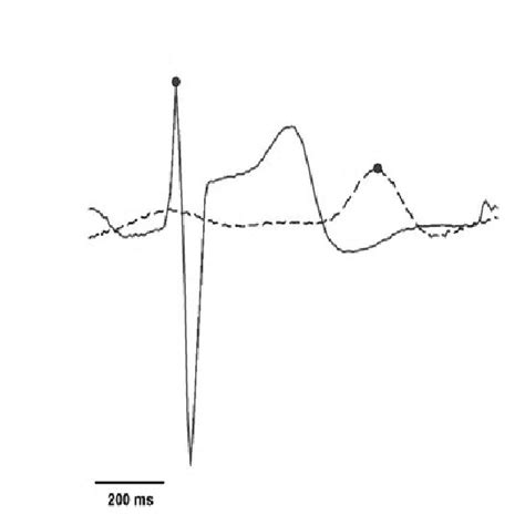 the electrocardiograph and first derivative of pulse signals ptt is