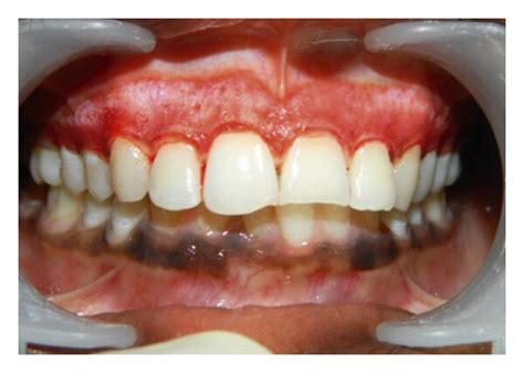 Scalpel Technique Control Group Preoperative View A Download