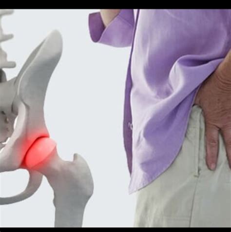 Приемът на определение витамини прави тазобедрената става чуплива За Жената