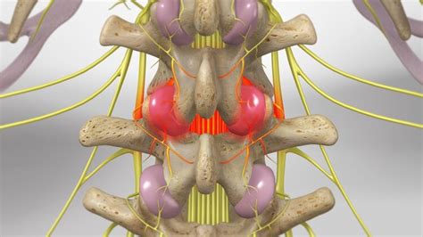Medial Branch Block Aptiva Health