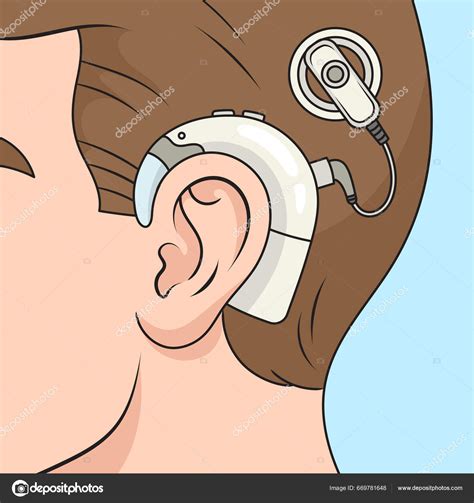 cochlear implant diagram
