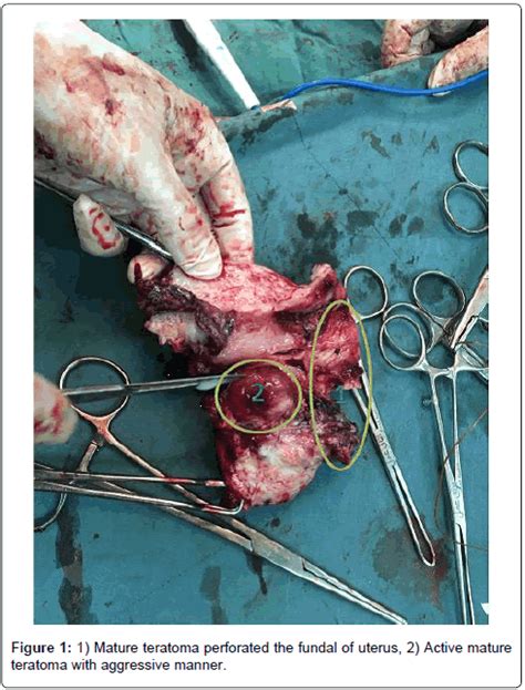 Oncology Cancer Case Reports Teratoma