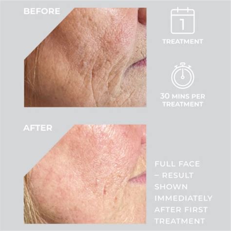 Advanced Radiofrequency Microneedling Dermaforce
