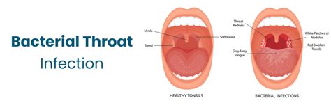 Throat Infection Symptoms Causes And Treatments