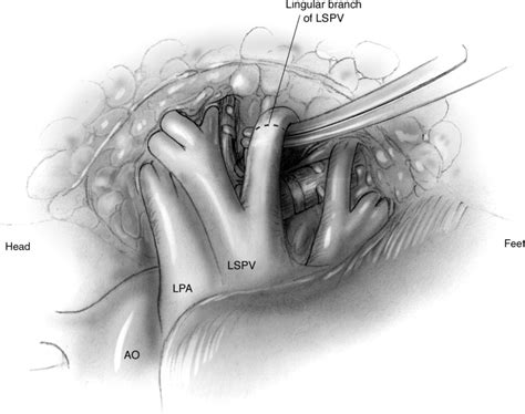 Technique Of Thoracoscopic Segmentectomy Operative Techniques In Thoracic And Cardiovascular