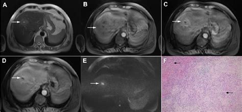 Figure 11 From Imaging Spectrum Of Intrahepatic Mass Forming Cholangiocarcinoma And Its