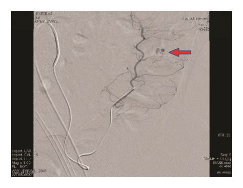 Super Selective Embolization A Before And B After Coil Deployment