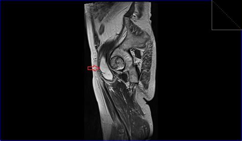 Iliopsoas Bursitis Mri Iliopectineal Bursitis Radiology Article