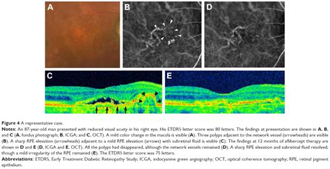 Efficacy Of Intravitreal Aflibercept Injections For Japanese Patients Opth