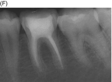 8 Mta Root Canal Obturation Pocket Dentistry