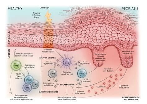 How Does Psoriasis Work Canadian Psoriasis Network