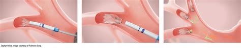 Endobronchial Valve Placement Advocate Health Care