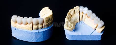 Fixed Dental Prosthesis Stock Image Image Of Sculpture 246640157