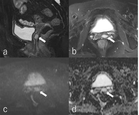 Figure 1 From A Vaginal Fibroepithelial Stromal Polyp A Case Report With Magnetic Resonance