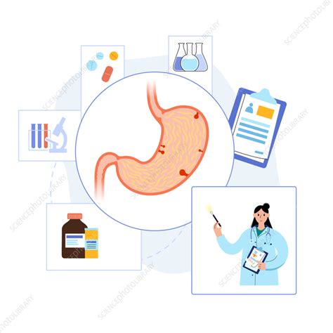 Stomach Polyp Removal Illustration Stock Image F036 5561 Science