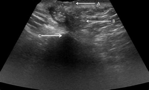 Preoperative Ultrasonographic Image Of Sacrococcygeal Pilonidal Disease