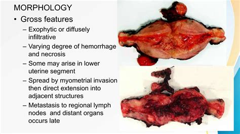 Carcinoma Of Endometrium Endometrioiod And Serous Carcinoma Of Uterine