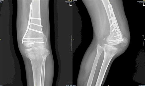 Surgical Treatment Of Femoral Medial Condyle Impaction Fracture Complicated With Hoffa Fragment