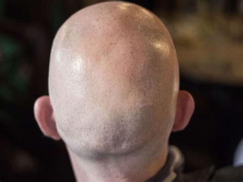 British Court Ruling A Man As Bald Is Considered Sexual Harassment Understand