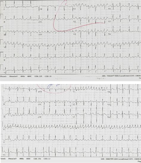Figure 1 3 From Giant Flutter Waves In Ecg Lead V1 A Marker Of Pulmonary Hypertension