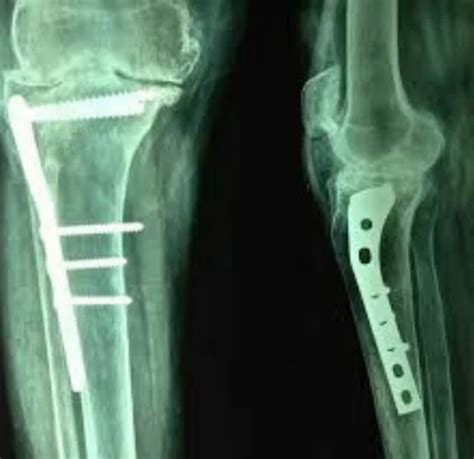 Complex Primary Knee Replacement In Kochi Id 9579881862