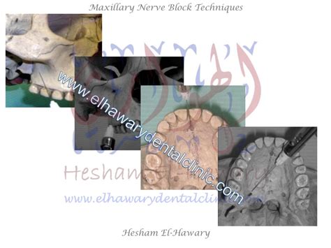 Maxillary Nerve Block Anesthetic Technique With Photos