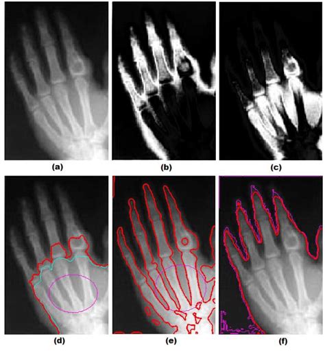 Selective Segmentation Of An X Ray Hand Image A X Ray Hand B C