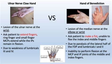 Hand Of Benediction Vs Ulnar Claw