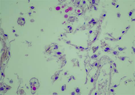 Cryptococcus Neoformans Gram Stain